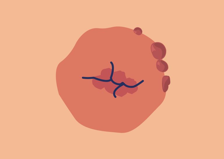 Stoma granulomas - Eakin Healthcare