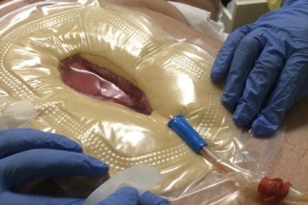 Wound - Eakin Healthcare